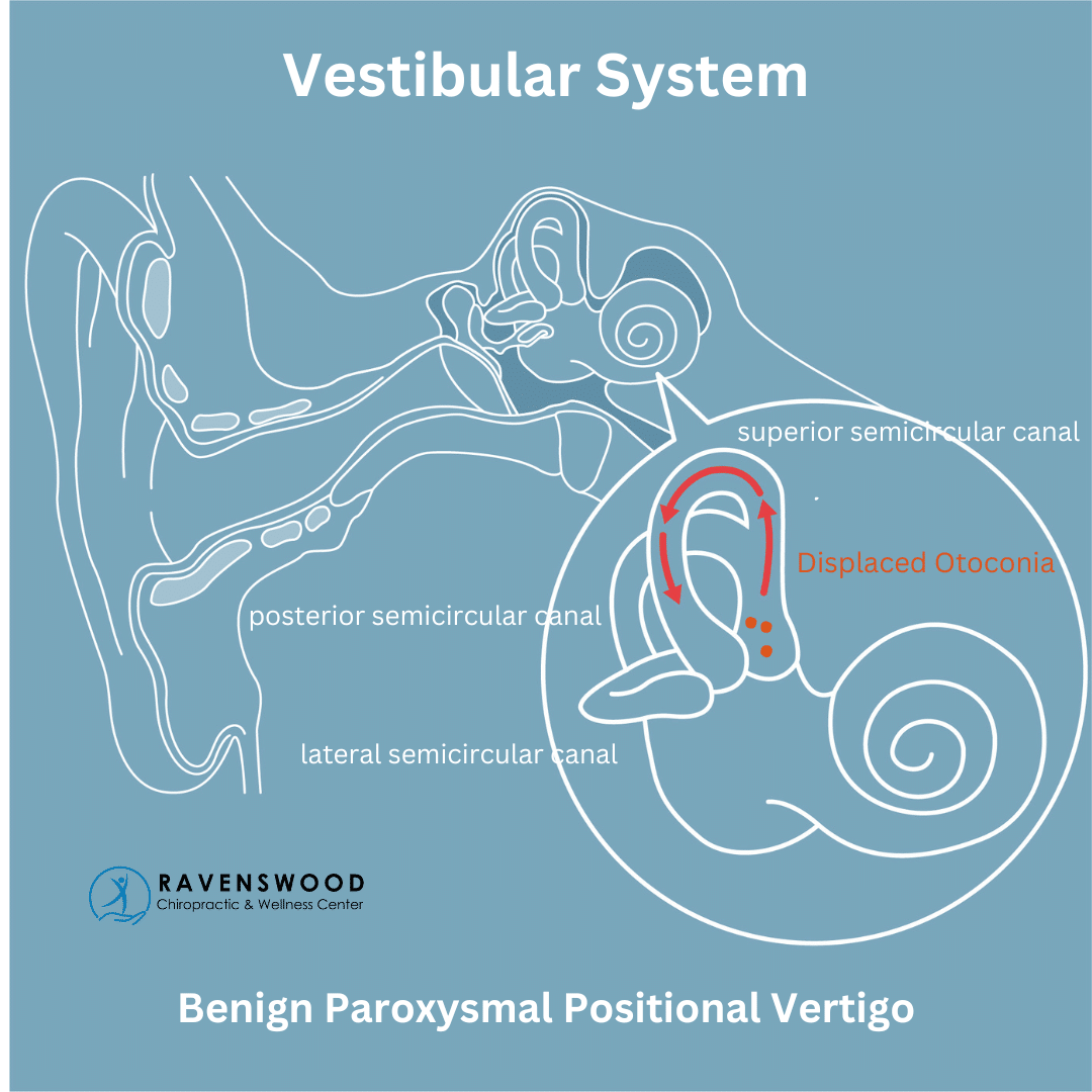 Can a Chiropractor Help With Vertigo - RennWellness